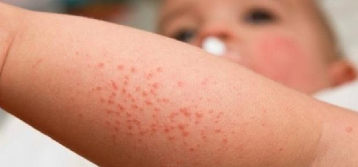 Due casi di scabbia nelle scuole di Leini - La Stampa