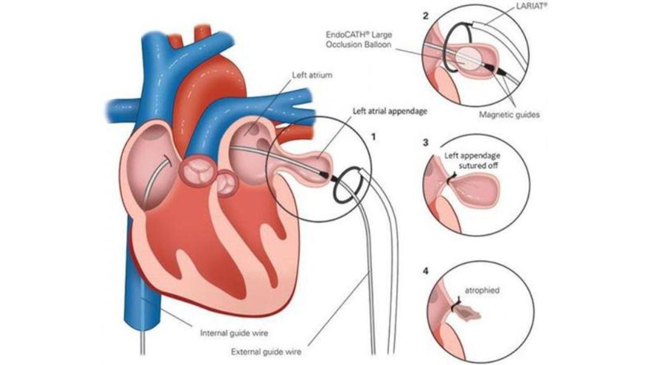 Fibrillazione atriale, a Torino il primo intervento al mondo con ...